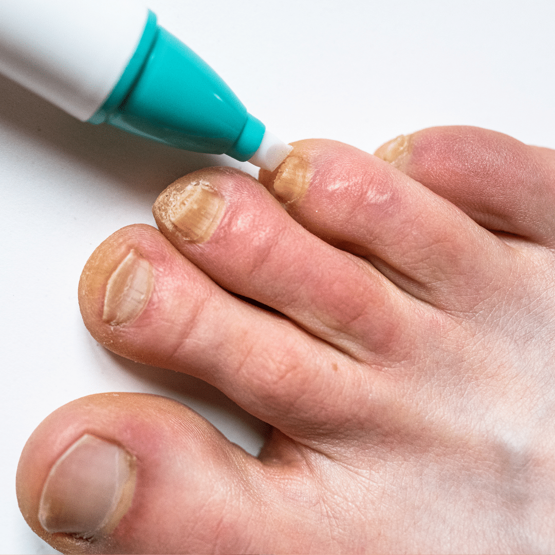 Laser Therapy for Fungal Nail Infections - Elite Foot Care - Sunshine ...