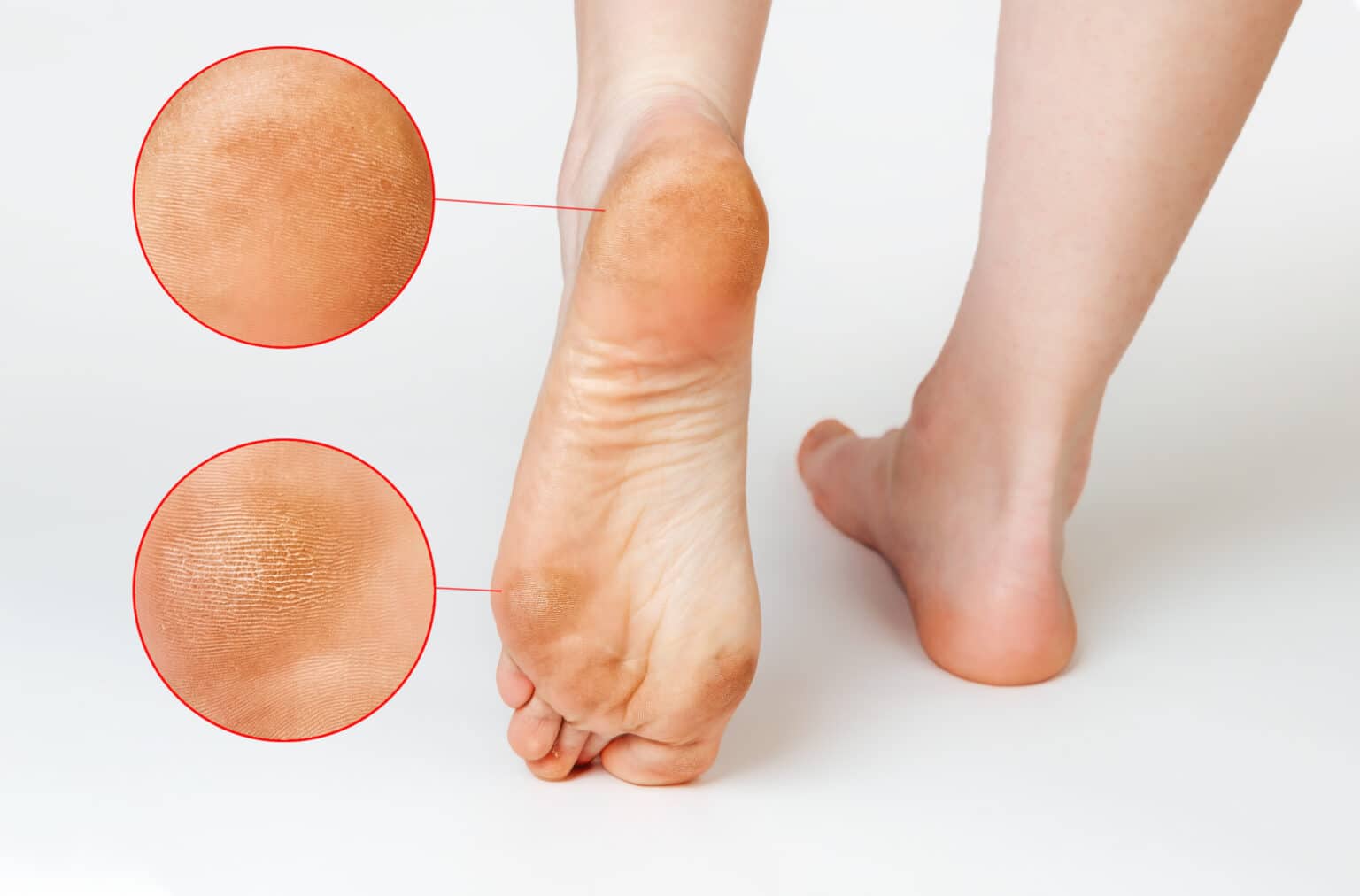 Cracked Heels - Causes, Symptoms & Treatments