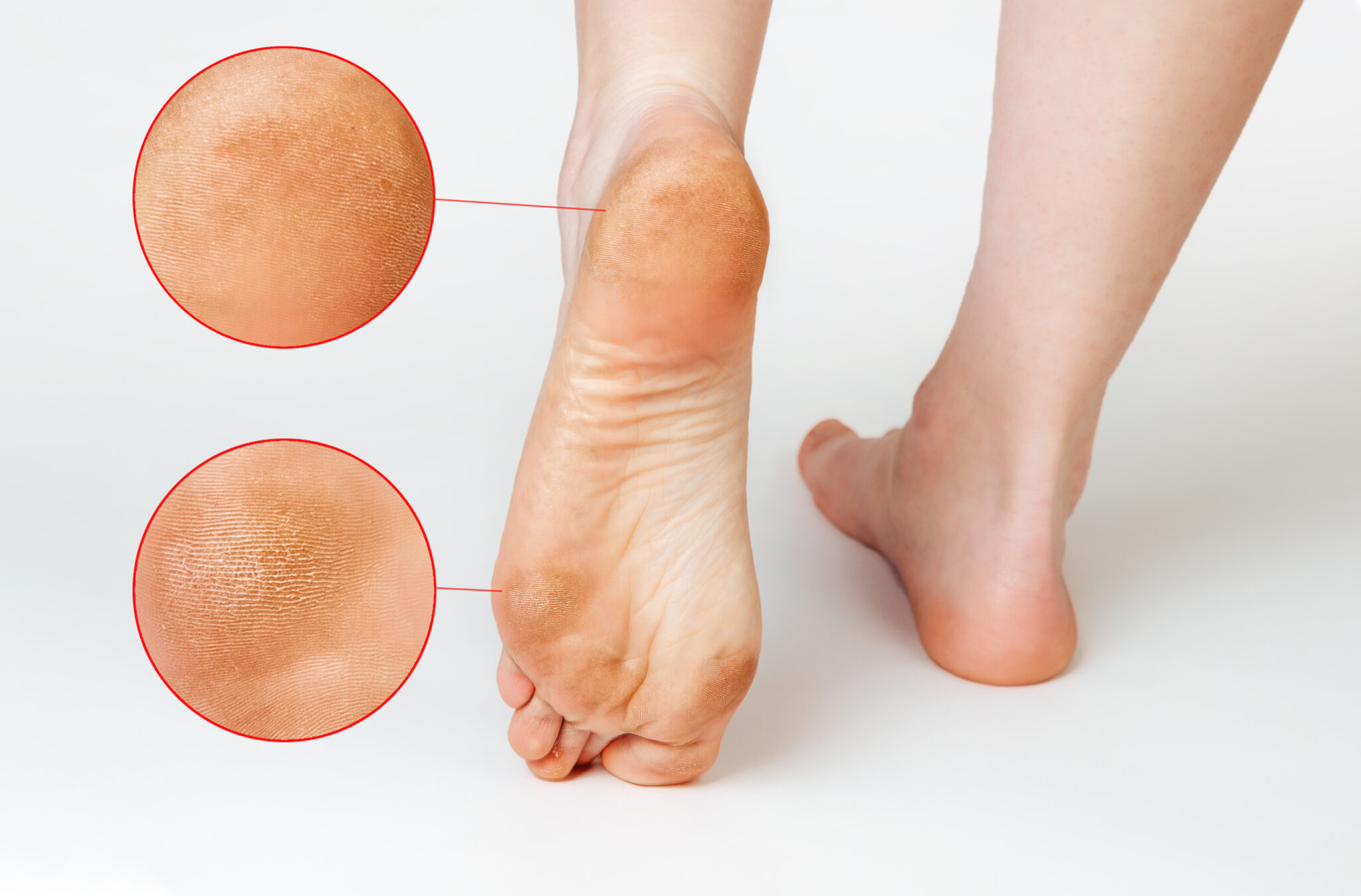 Cracked Heels - Causes, Symptoms & Treatments