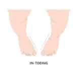 Pigeon Toes (Intoeing) - Symptoms, Causes & Treatment