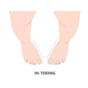 Pigeon Toes (Intoeing) - Symptoms, Causes & Treatment