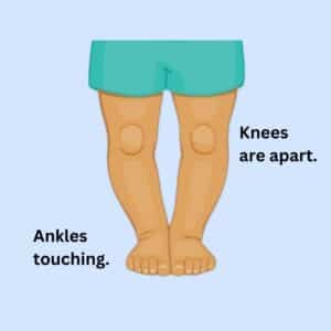 Bowed Legs - Symptoms, Causes & Treatment