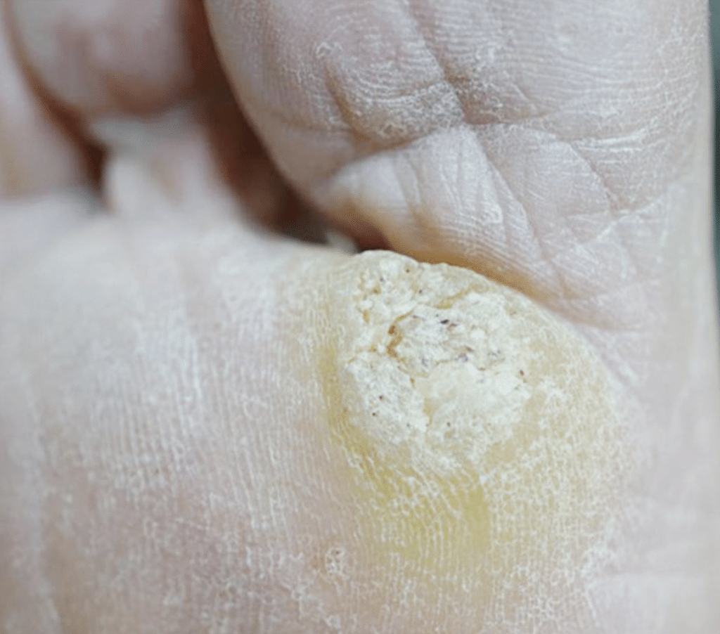 Plantar Warts - Symptoms, Causes & Treatments