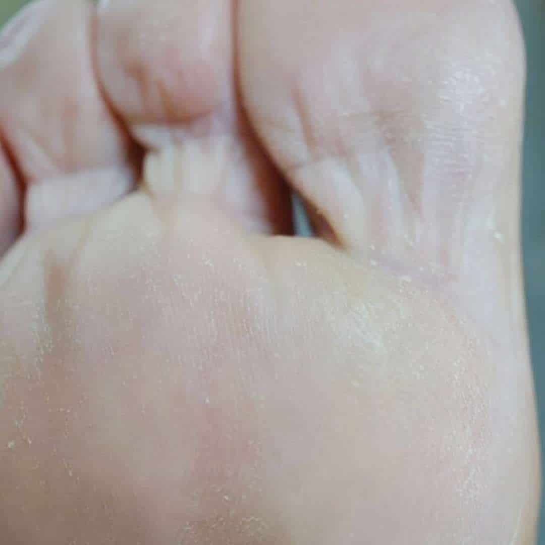 SWIFT Microwave Wart Therapy - Sunshine Coast Podiatrists