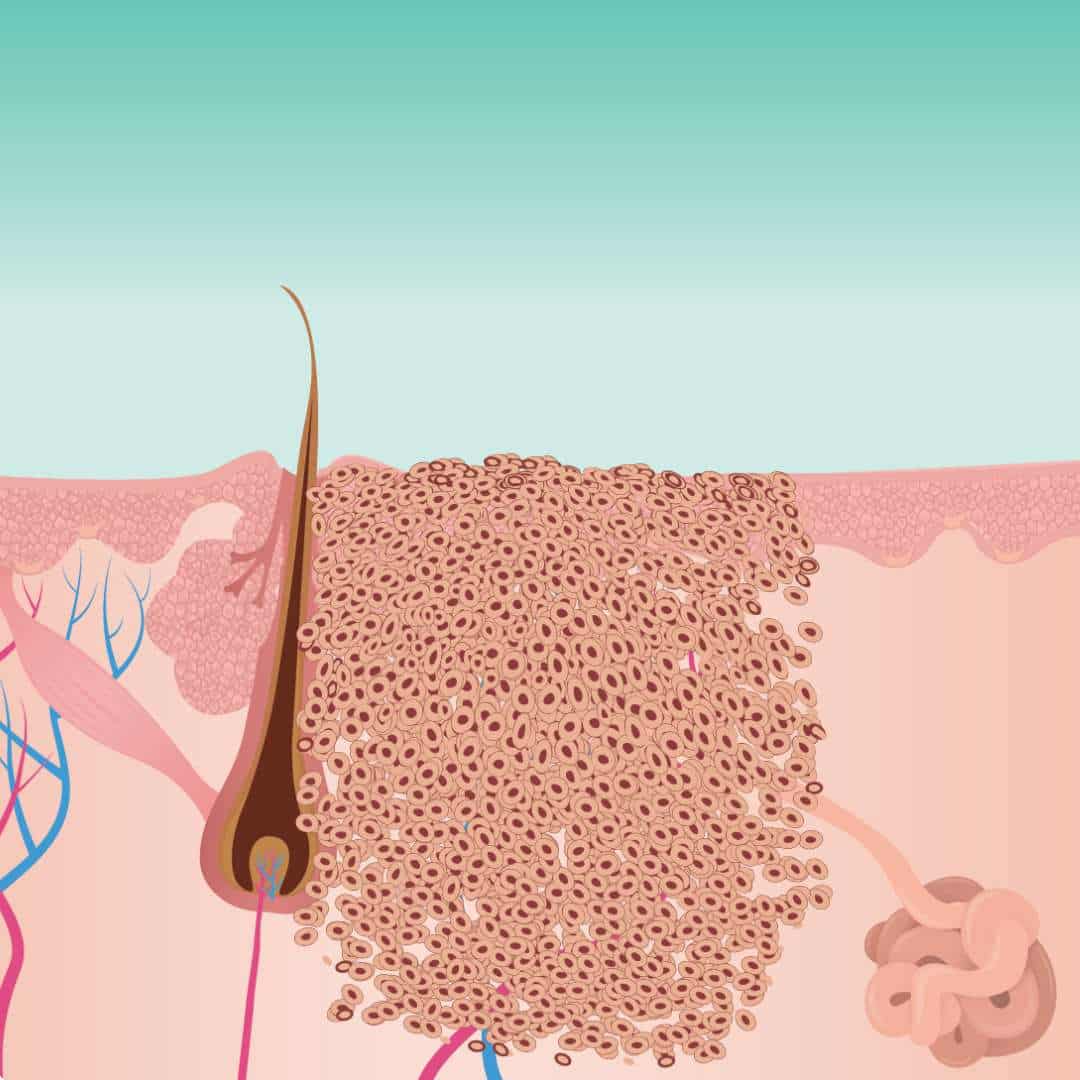 SWIFT Microwave Wart Therapy - Sunshine Coast Podiatrists
