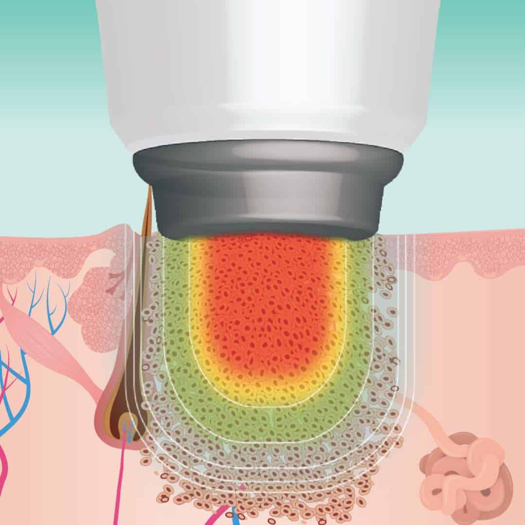 SWIFT Microwave Wart Therapy - Sunshine Coast Podiatrists
